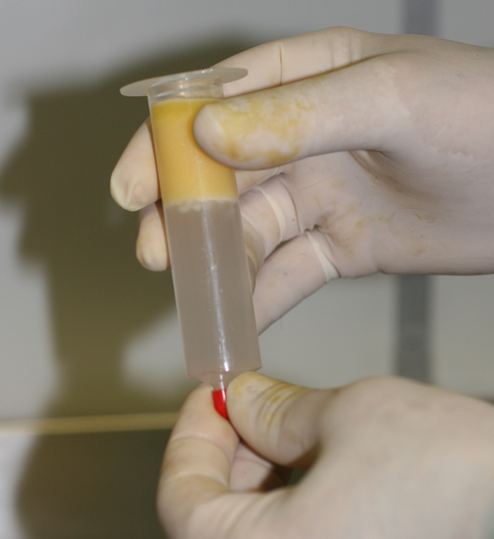 Adipofilling® | Korpo.com