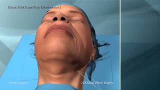 Korpo.com – Elastic_Plastic_surgery_Elasticum_suture_3d-elastic-macs ...