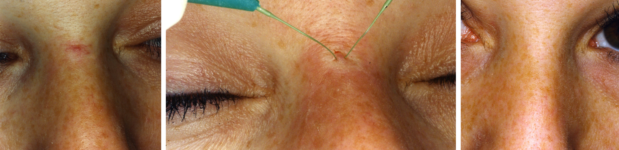 TIMED TD50 Micropulse | Korpo.com