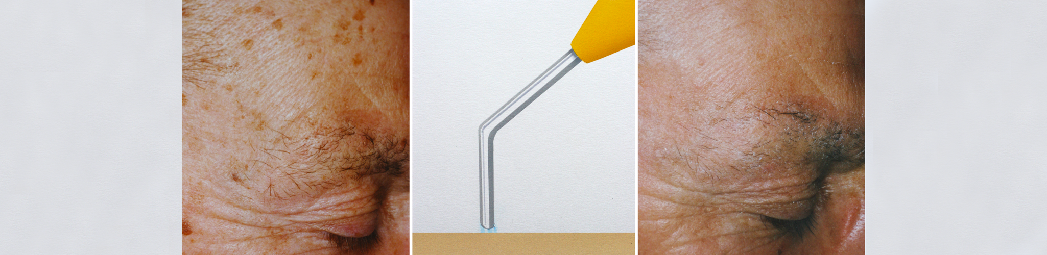 Timed Surgery Procedure | Korpo.com